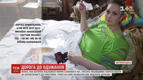 Жінка яка потерпає від важкої форми слоновості ніг просить допомоги