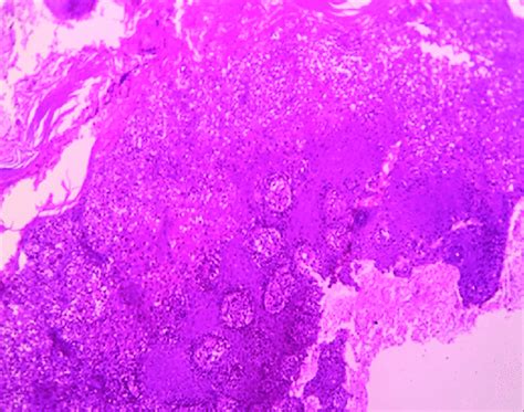 Psoriasiform Hyperplasia With Macropustule Seen Just Beneath The Download Scientific Diagram