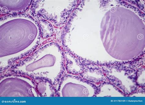Benign Prostatic Hyperplasia Light Micrograph Stock Image 311783023