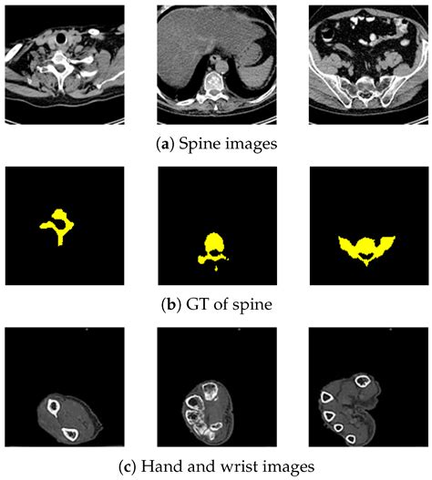 Data Efficient Bone Segmentation Using Feature Pyramid Based Segformer