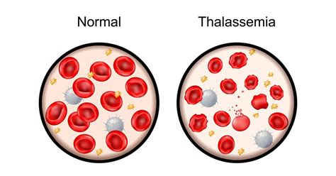 Thalassemia Major Vs Thalassemia Minor Understanding The Differences