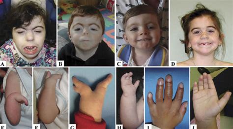 Cornelia De Lange Syndrome Causes Symptoms Prognosis And Treatment