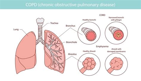 Copd Diagram Over 132 Royalty Free Licensable Stock Illustrations