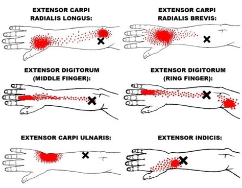 The Wrist Extensors Are A Group Of Nine Muscles On The Back Of The