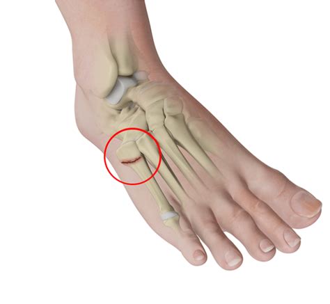 Jones Fracture Bunbury Foot And Ankle Surgeon