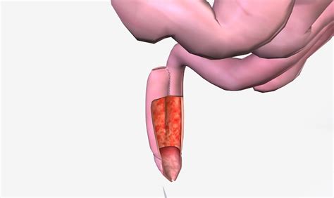 Premium Photo Pouchitis Many People With Severe Ulcerative Colitis