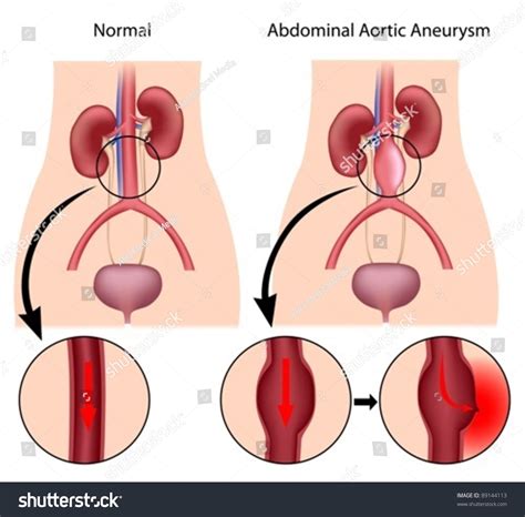 Abdominal Aortic Aneurysm Over 391 Royalty Free Licensable Stock