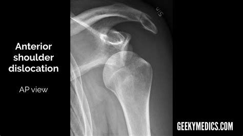 Shoulder X Ray Interpretation Radiology Geeky Medics