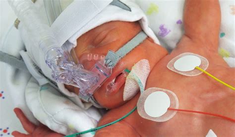 Mekanisk Ventilator Nicu
