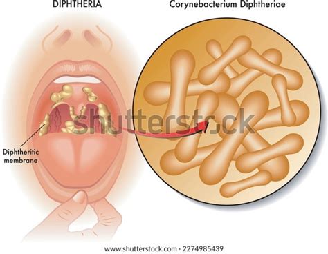 Corynebacterium Diphtheriae Colony Morphology