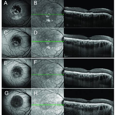 Fundus Autofluorescence Faf And Optical Coherence Tomography Oct
