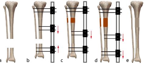 Figure 2 From Reconstruction Of Long Segmental Tibial Bone Defect Using The Bone Transport