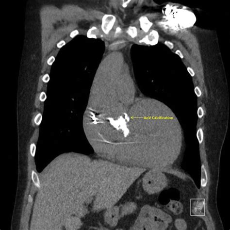 Retrospectively Gated Dual Source Cardiac Ct Scan Showing Fistulous
