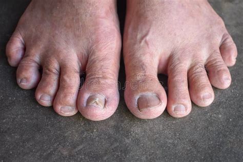 Old Mans Feet Dry Foot And Skin Aging Stock Image Image Of Toenail