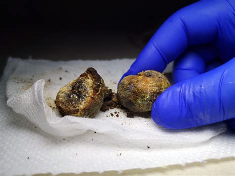 Nice Gallstone Disease Nasgp
