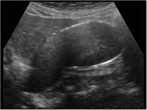 Abdomen And Retroperitoneum 12 Gallbladder And Bile Ducts Case 12