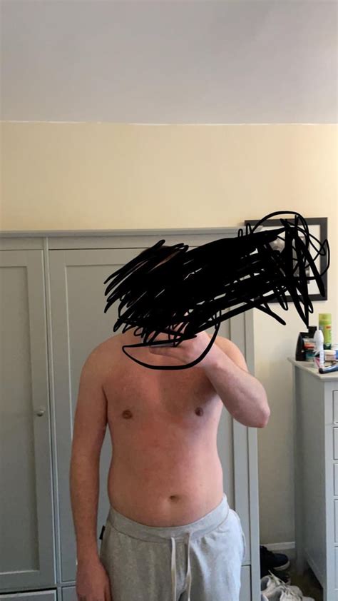 15 Week Post Gyno Op What Do You Guys Think Rgynecomastia