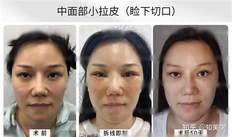 成都拉皮哪个医生做比较靠谱？ 知乎