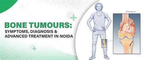 Bone Tumours Symptoms Diagnosis And Advanced Treatment In Noida