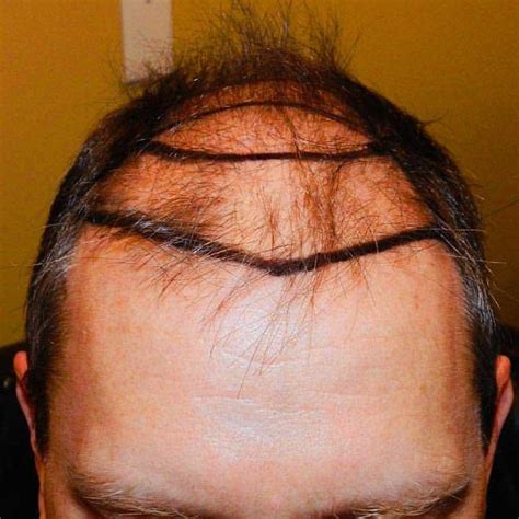 植发医院为什么敢承诺毛囊存活率95？这是真的吗？ 知乎