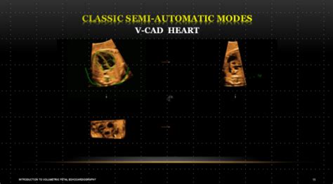 4d Fetal Echocardiography Tohamy 4d Scan
