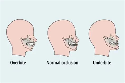 Overbite Vs Underbite Causes And Treatments