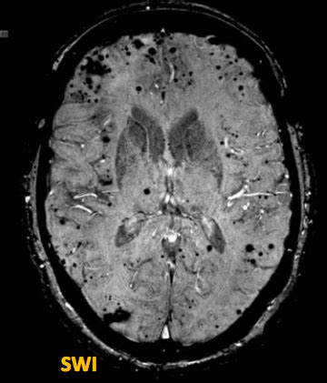 Swi Susceptibility Weighted Imaging For Mri After Tbi