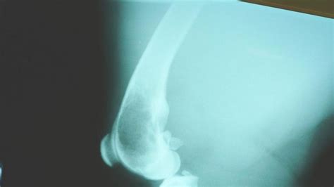 ¿qué Es Un Osteosarcoma La Enfermedad Que Sufría Xana La Hija De Luis