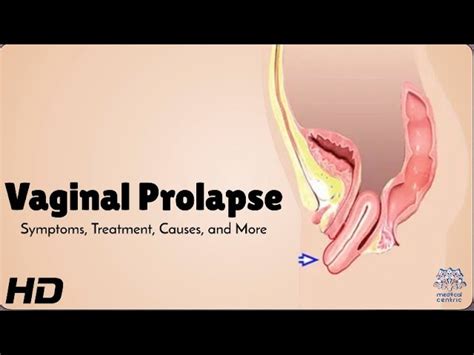 Early Vaginal Prolapse Cystocele Prolapsed Bladder Symptoms