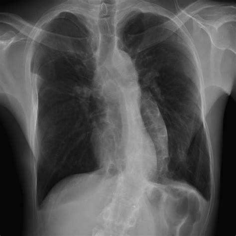 Preoperative Chest X‐ray Showed Scoliosis Download Scientific Diagram