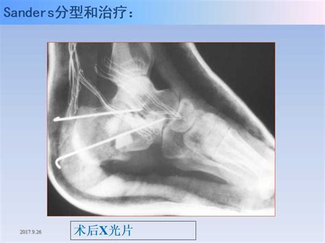 跟骨骨折的临床治疗方式及其要点 好医术早读文章 好医术 赋能医生守护生命