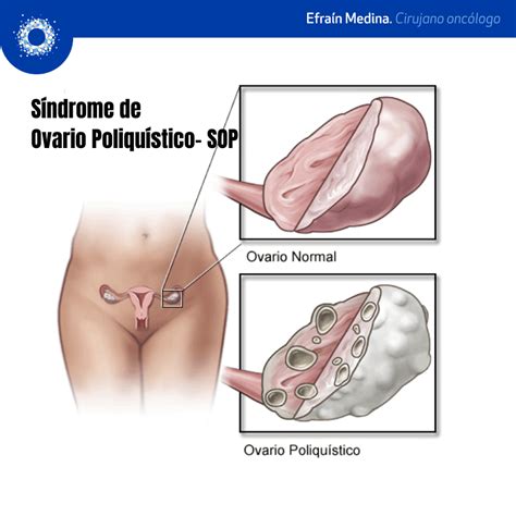 Síntomas De Quistes En Los Ovarios Después De La Menopausia Gastropatios