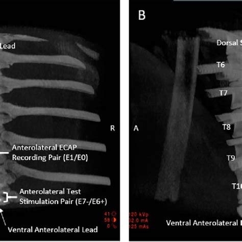 Example Lead Placement Intraoperative Computed Tomography Download