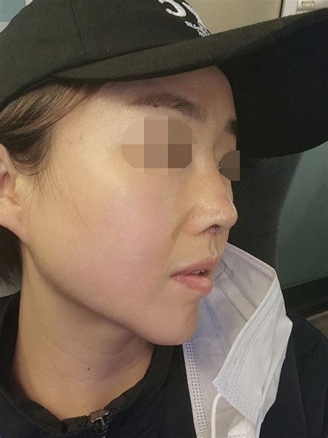 왜 다들 민원장님보고 아버지라고 하는지 느꼈어요 수술후기 나를 위해 선택한 차민성형외과