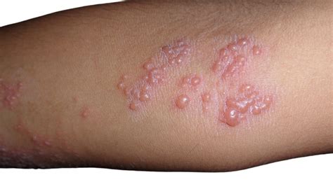 Shingles Treatment Shingles Treatment And Prevention Primary Care In