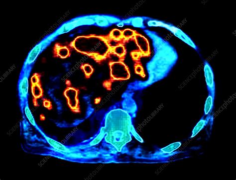 Liver Metastases PET CT Scan Stock Image C017 4433 Science