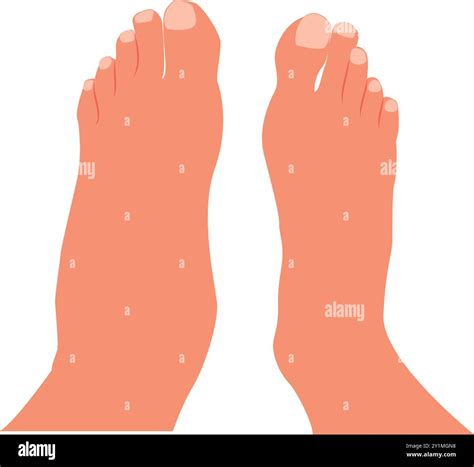 Swollen Foot Normal Foot Before After Healthcare Illustration