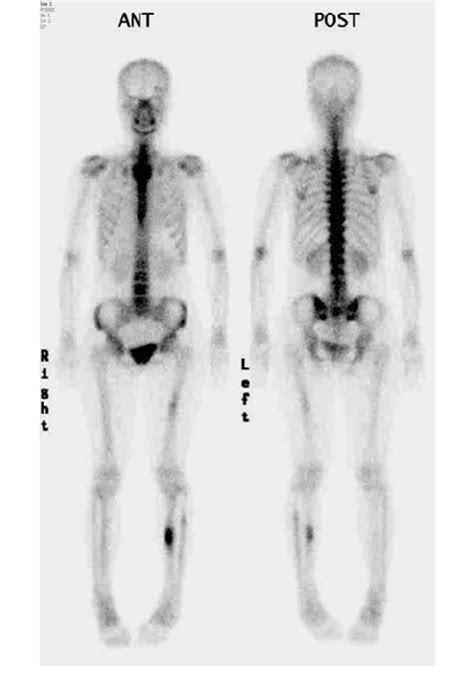 A Tc 99 MDP Bone Scan Obtained In February 2005 8 Years After Onset Download Scientific