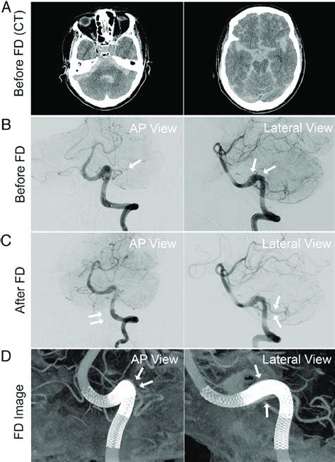 A Dissecting Aneurysm On The Left Va Treated By Fd A Axial Ct Head