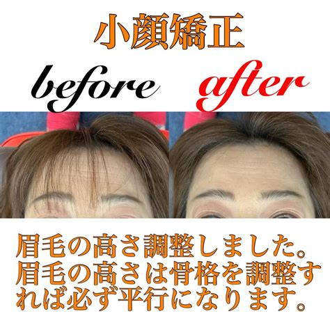 眉毛の高さが大幅に違う方、必ず記事を最後まで読んで下さい。眉毛の高さは小顔矯正で必ず平行に出来ます。【小田原】 ブログ