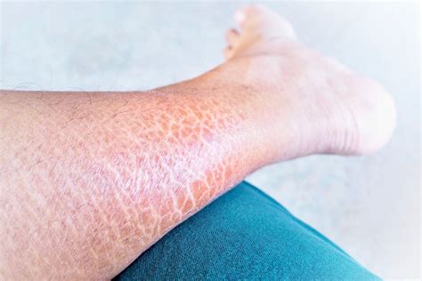 40 Facts About Congenital Ichthyosis