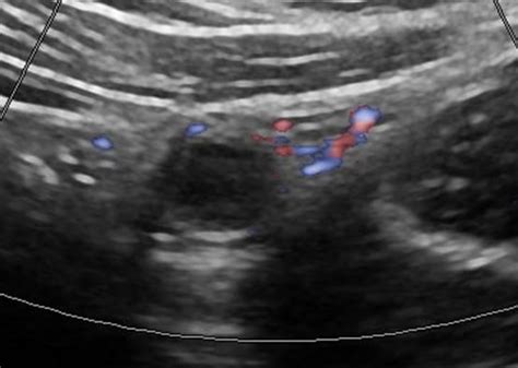 Pediatrics 9 1 Pediatric Abdomen And Retroperitoneum Case 9 1 7 Appendix Ultrasound Cases
