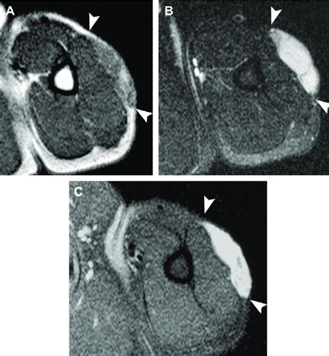 Dfsp Dfsp In A 21 Year Old Man Who Presented With A Slow Growing Upper