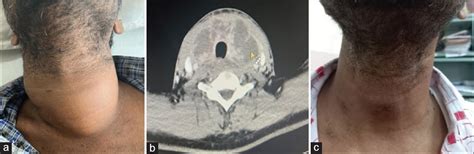 Metastatic Thyroid Abscess A Rare Presentation Of Catheter Related