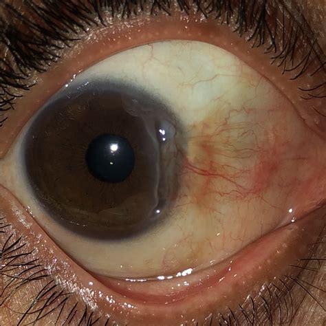 Ulcer On Eye
