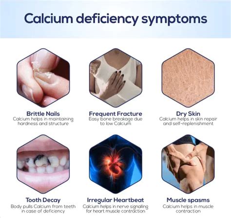 7 Calcium Deficiency Symptoms And Signshypocalcemia Updated 2024