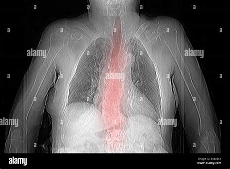 Computed Tomography Of A Grandmother After A Fall With Osteoporosis And