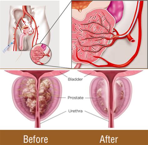 Prostate Enlargement Expert Ir Neuro And Vascular Clinic