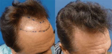 Can Smoking Cause Hair Loss Hair Restoration Specialists