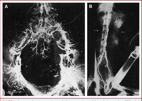 Figure 7 From History Of The Vertebral Venous Plexus And The